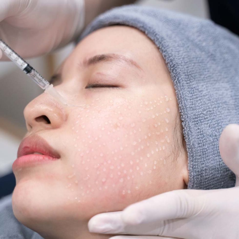 Acne Scar Treatment Malaysia | Clear Skin - Klinik Nur Raisha